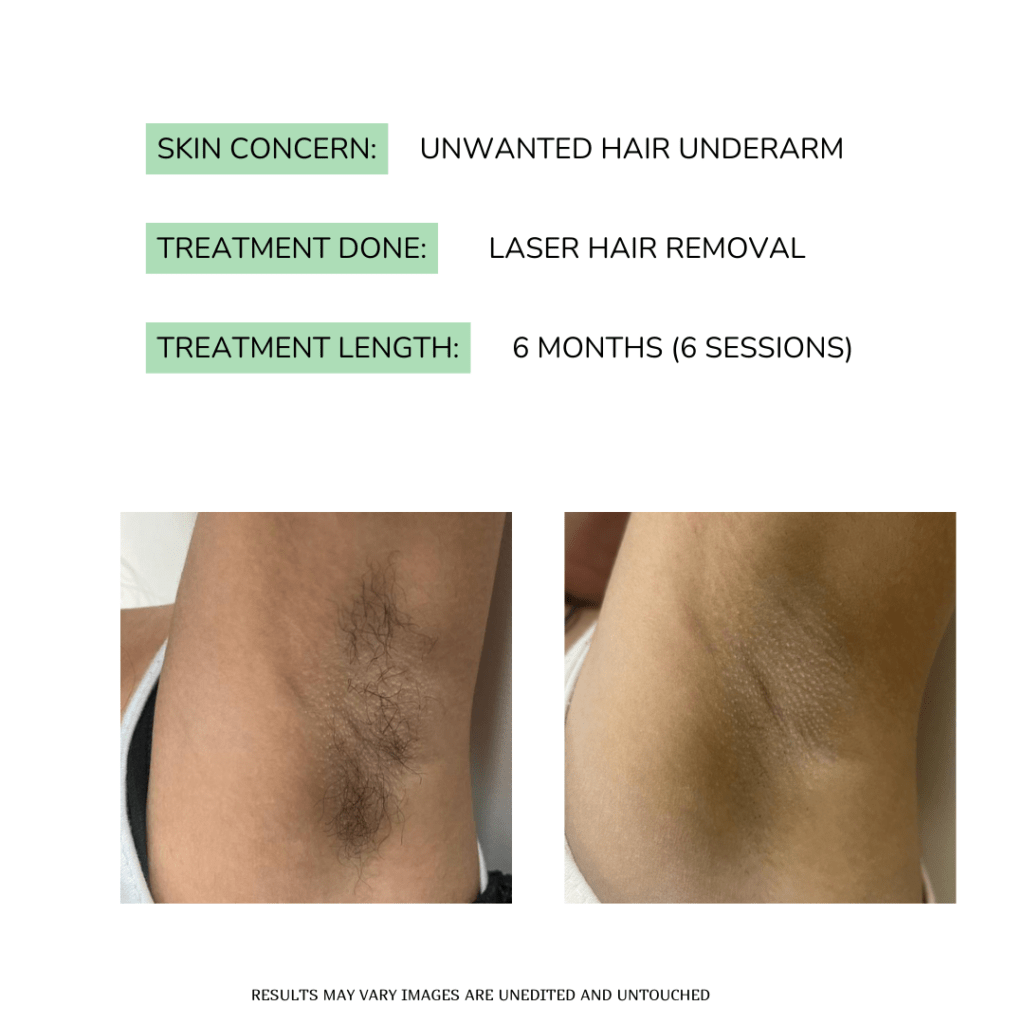 full-body-laser-hair-removal - Evenly