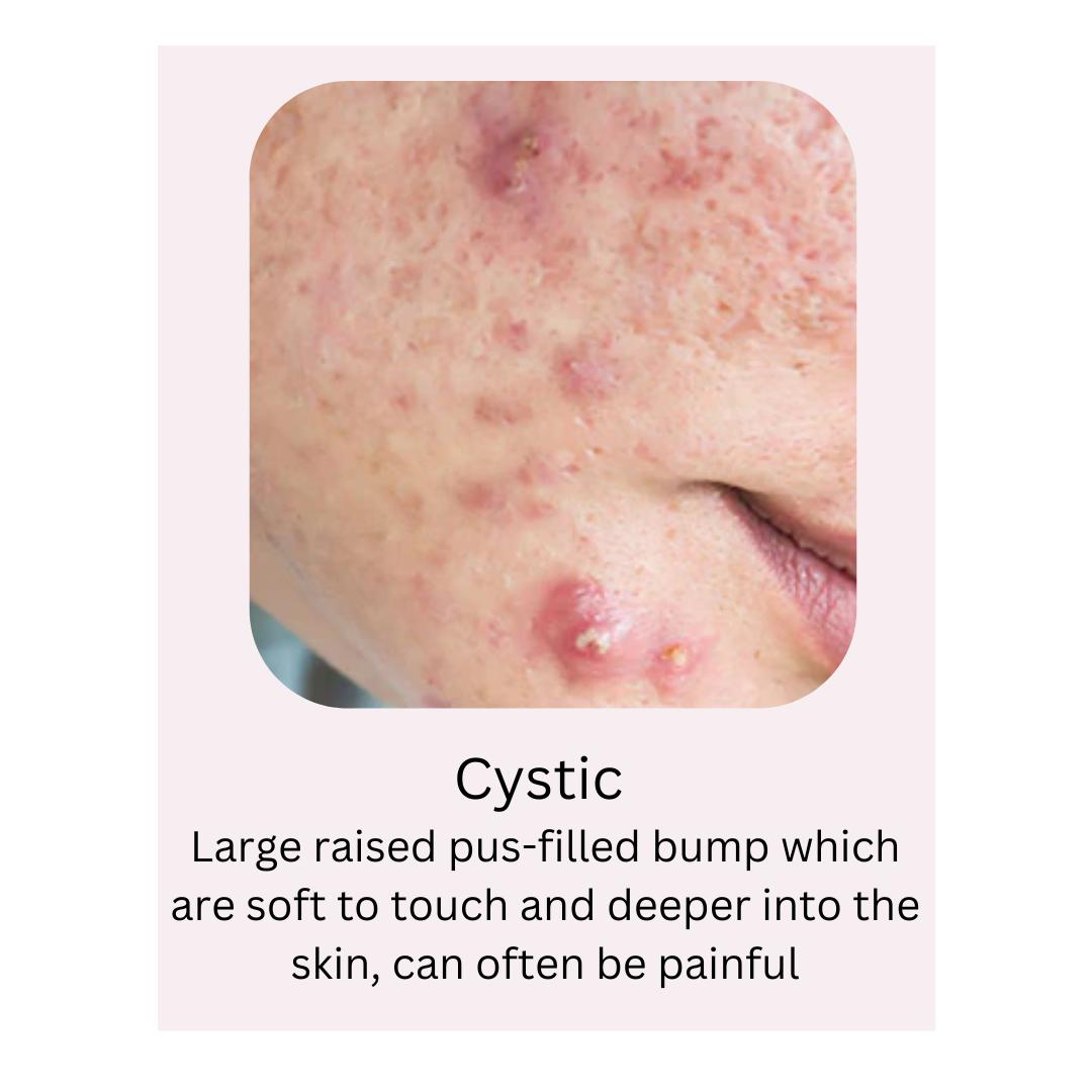 How to Get Rid of Forehead Acne: Causes and Solutions