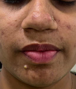 How to Get Rid of Pus Filled Pimples: Treat Pimples with Pus