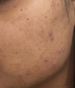 How to Get Rid of Scars On Face? Permanent Scar Removal