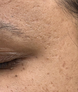 How to Treat Rolling Scars: Ultimate Treatments for Smooth Skin